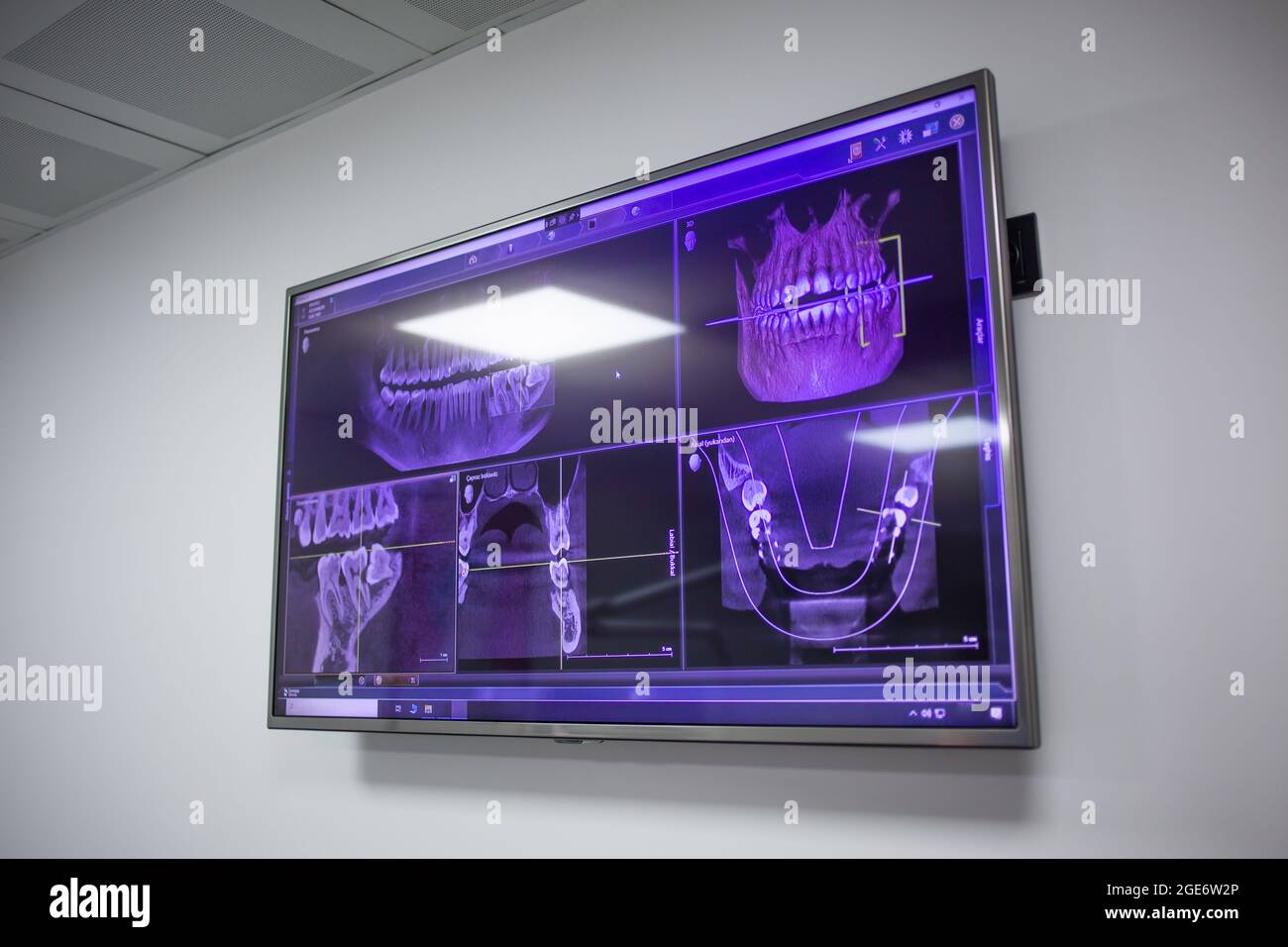 Tv screen in a dental office with x-ray of patient's teeth Stock Photo ...