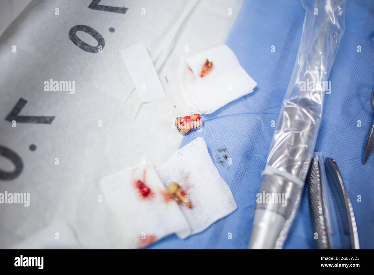 Extracted wisdom teeth on a medical tray table with dental tools and ...