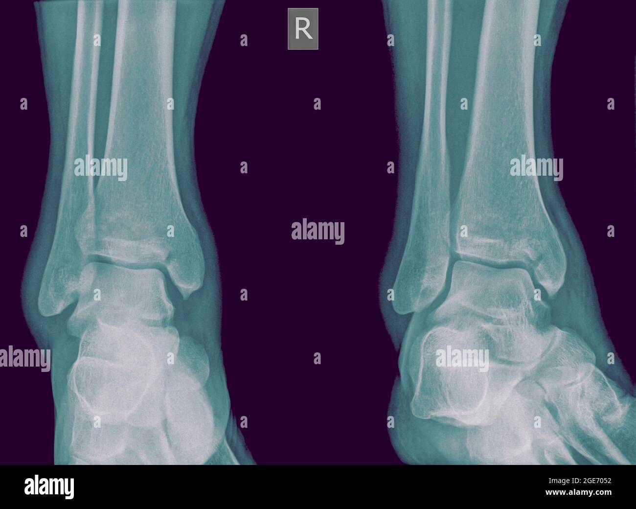 X-ray of an ankle 50 year old male with a fractured tibia. Front view ...