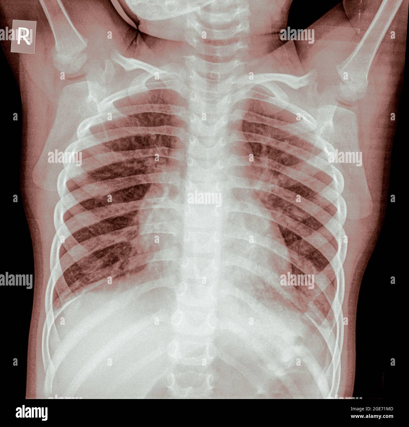 Normal Chest X Rays Pictures Normal Chest X Rays Pictures