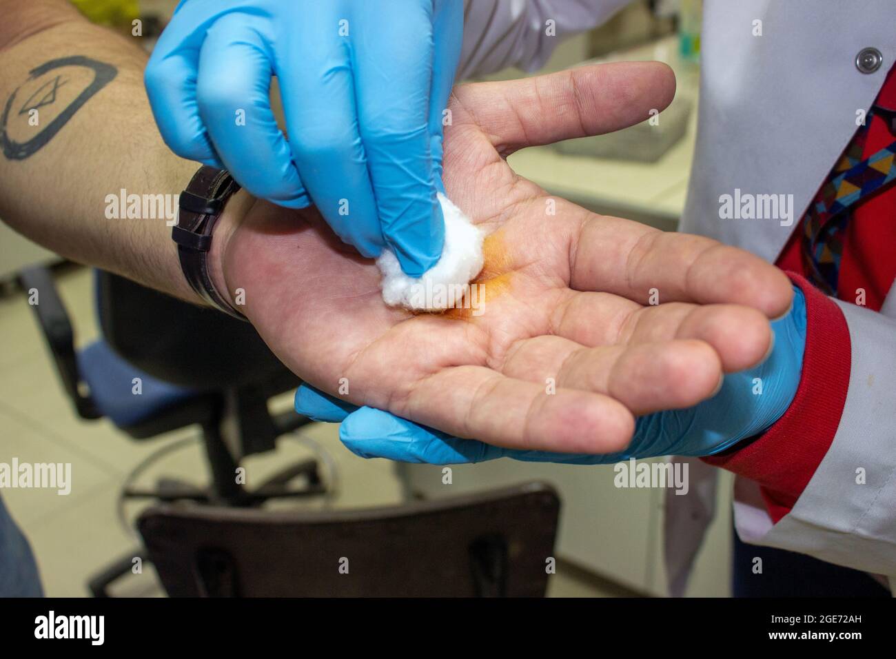Palm cut treatment with iodine (tincture of iodine). Medical concept ...