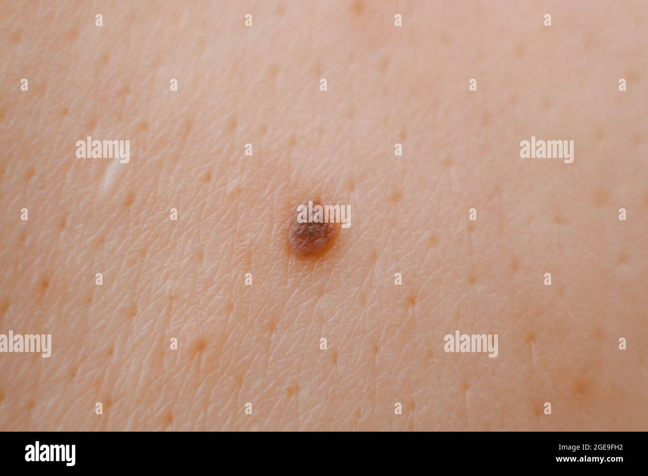 Detailed view of the nevus mole and the texture of human skin Stock ...
