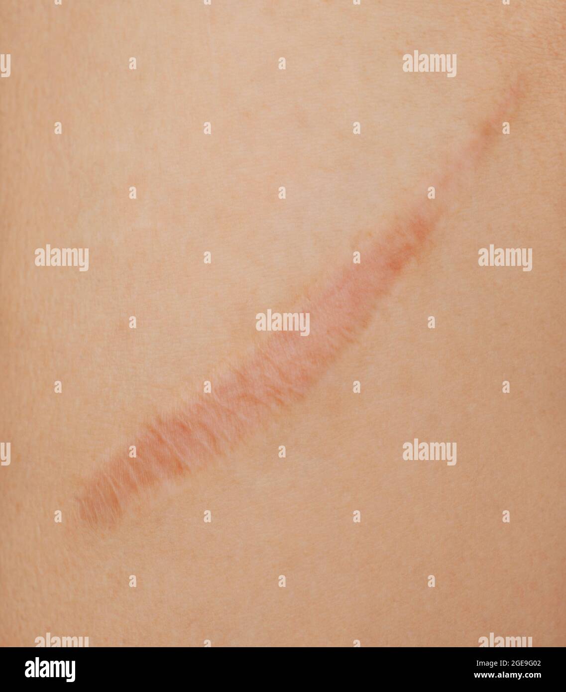 Body with scar hi-res stock photography and images - Alamy