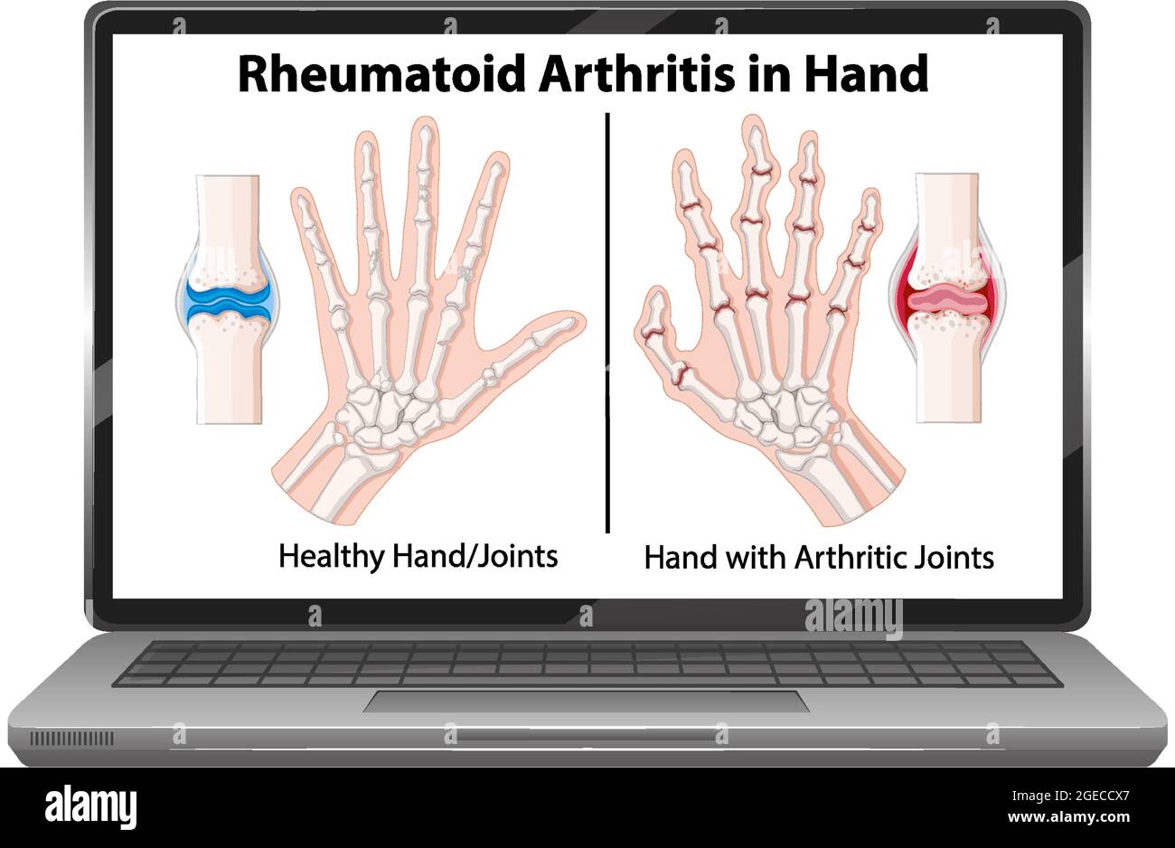 Rheumatoid arthritis symptoms on hand on laptop screen illustration ...