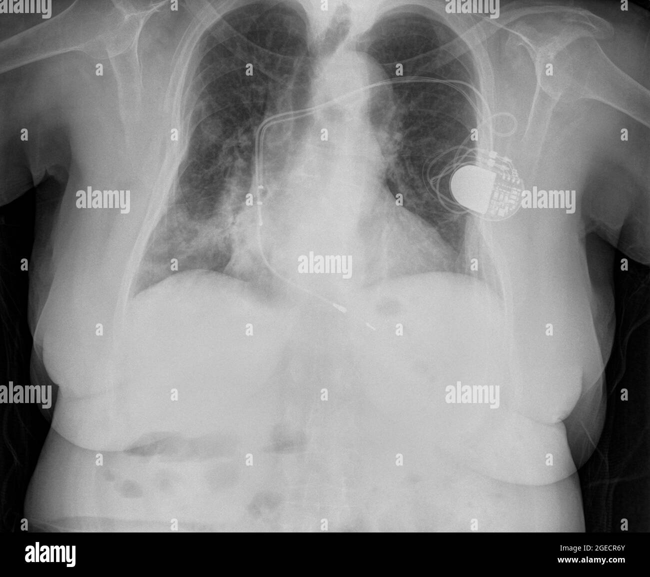 chest x-ray of an 82 year old female patient with a pace maker Stock ...