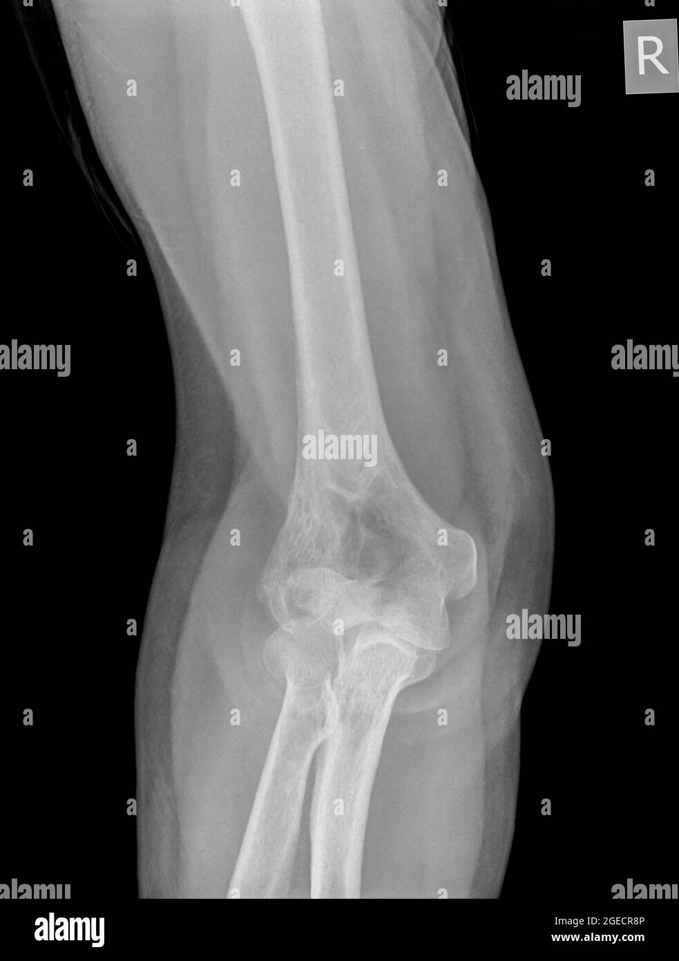 Humerus Anatomy Xray
