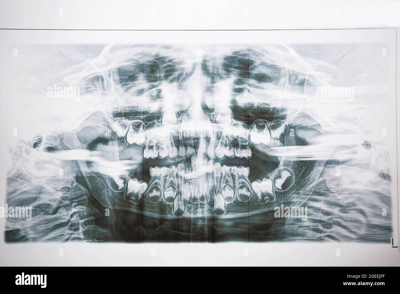 Dental X-ray of the baby's milk and molars. Two rows of teeth, change ...