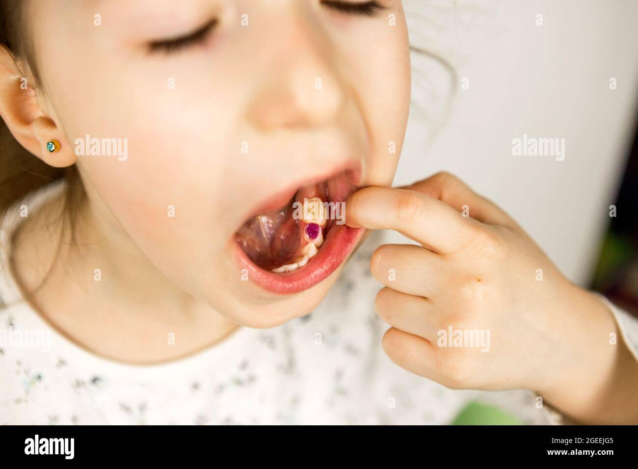 Colored purple filling on the girl's milk chewing tooth. Pediatric ...