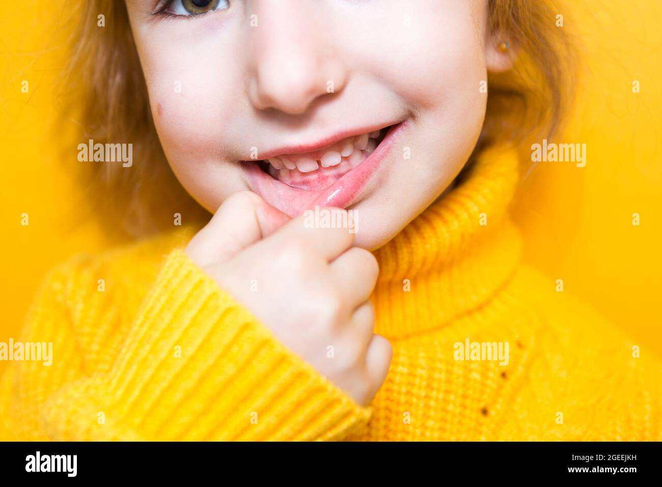 Girl shows her teeth-pathological bite, malocclusion, overbite ...