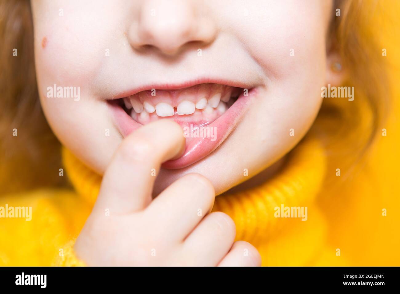 Girl shows her teeth-pathological bite, malocclusion, overbite ...
