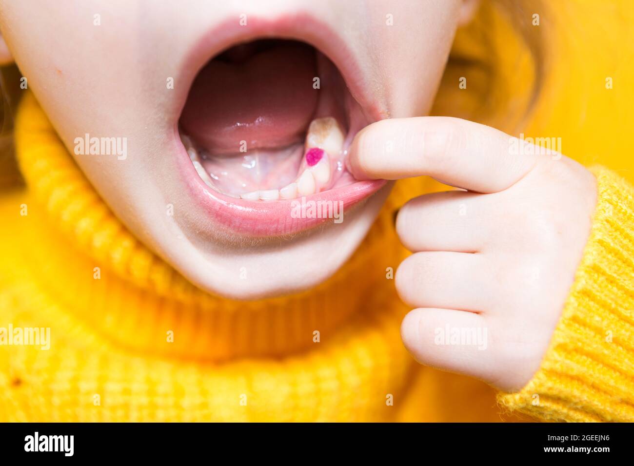 Colored purple filling on the girl's milk chewing tooth. Pediatric ...