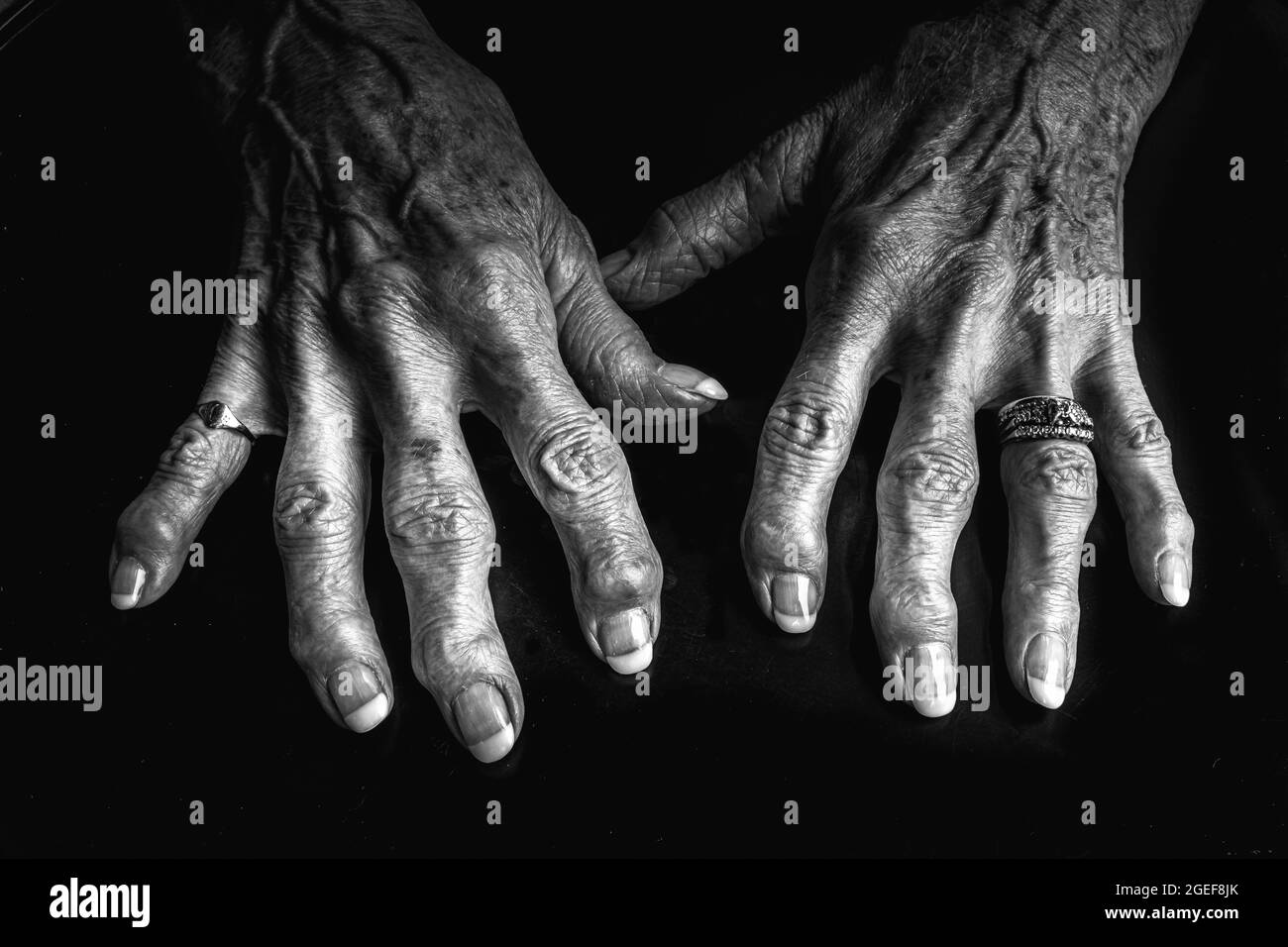 Skin swollen Black and White Stock Photos & Images - Alamy