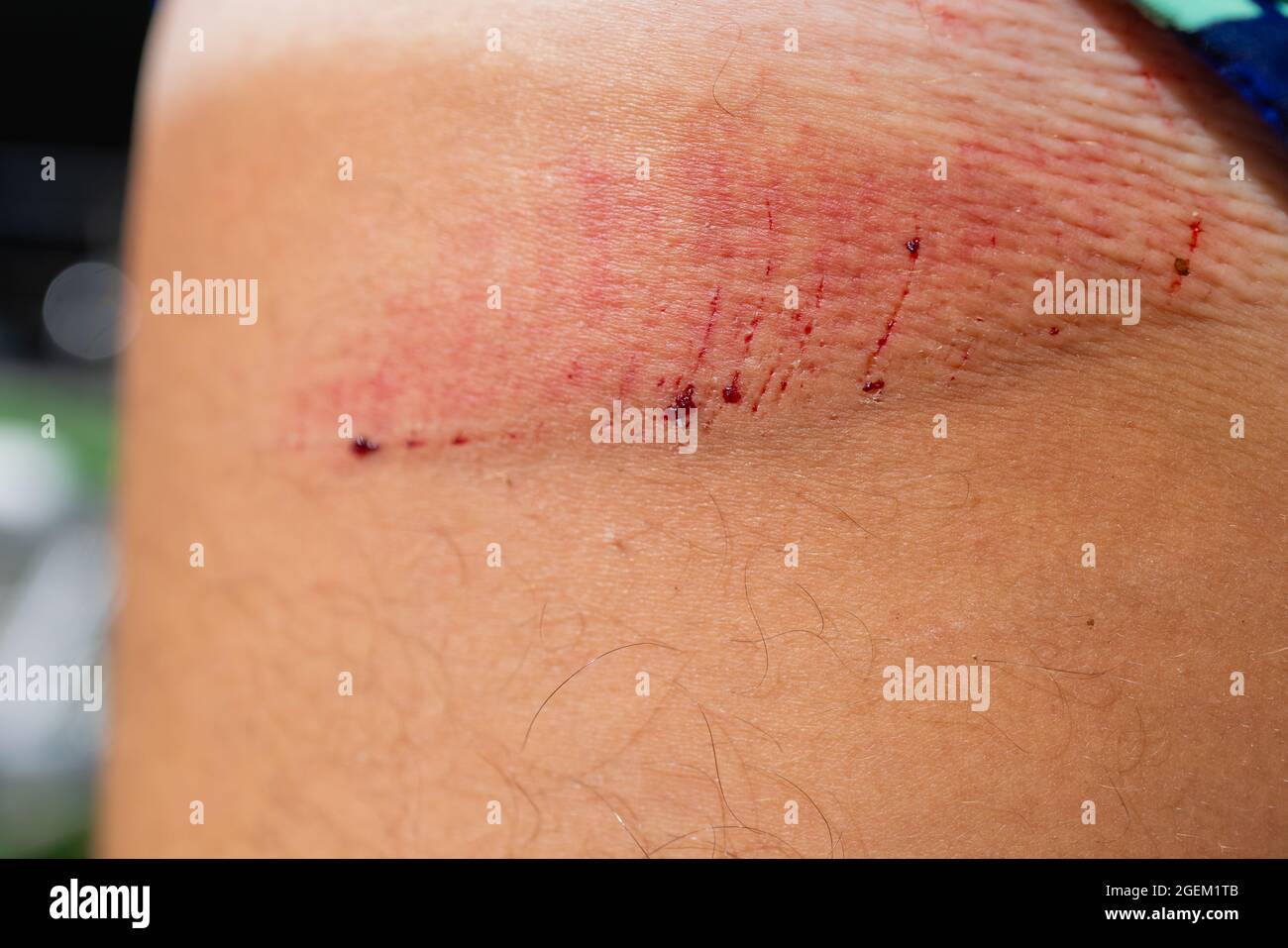 scratch lesion caused by the accident on leg skin Stock Photo - Alamy