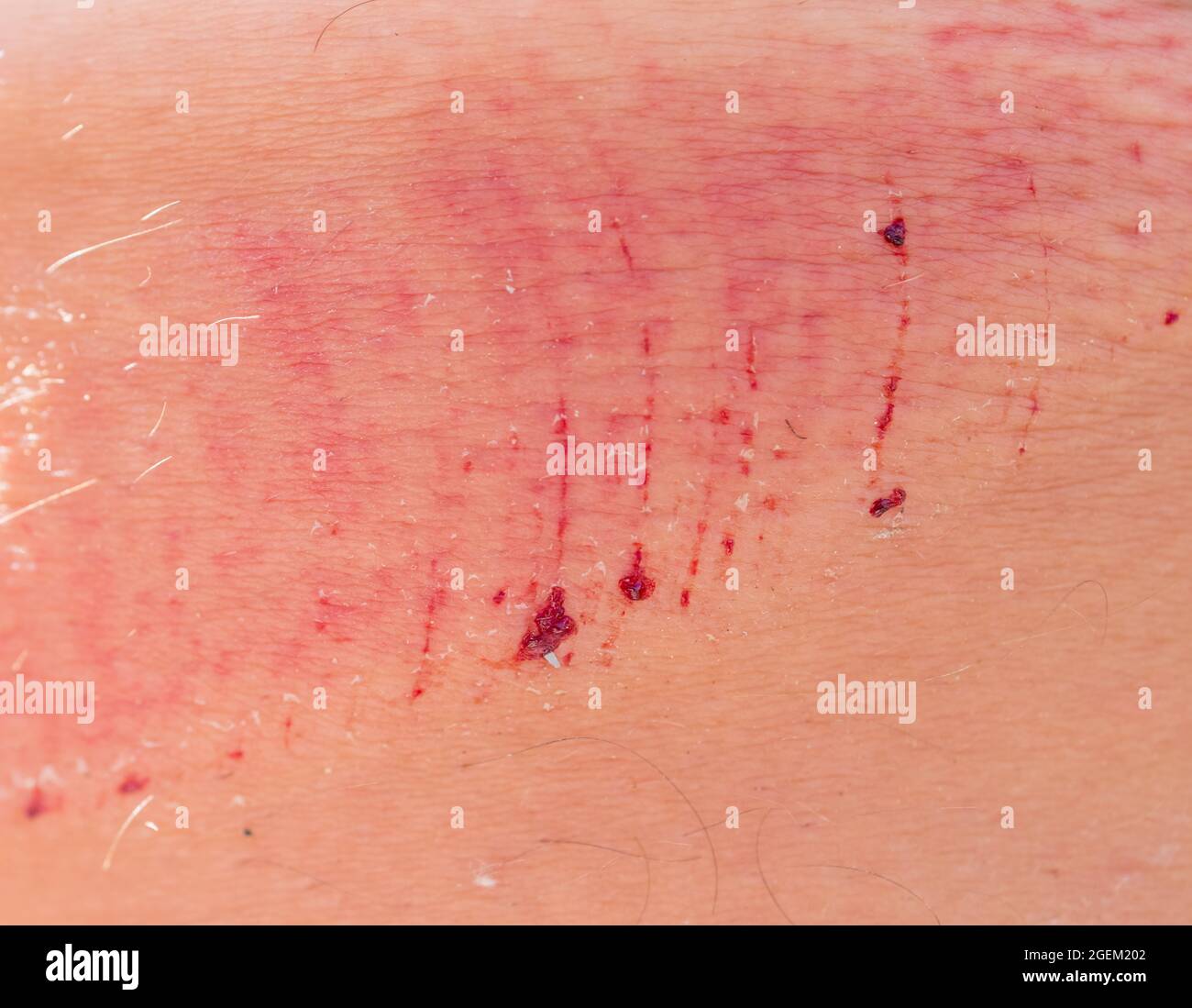 scratch lesion caused by the accident on leg skin Stock Photo - Alamy