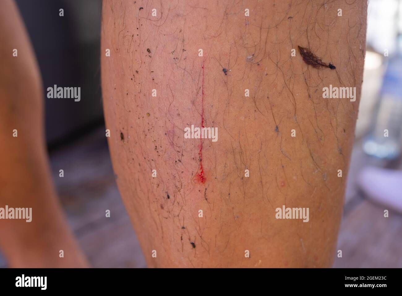scratch lesion caused by the accident on leg skin Stock Photo - Alamy