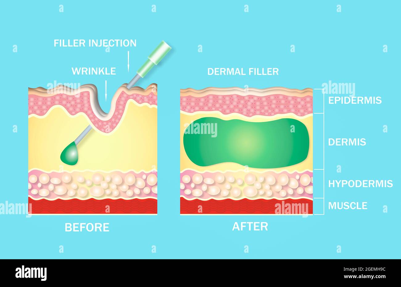 Injectable cosmetic filler or dermal fillers. Before and after. Lifting ...