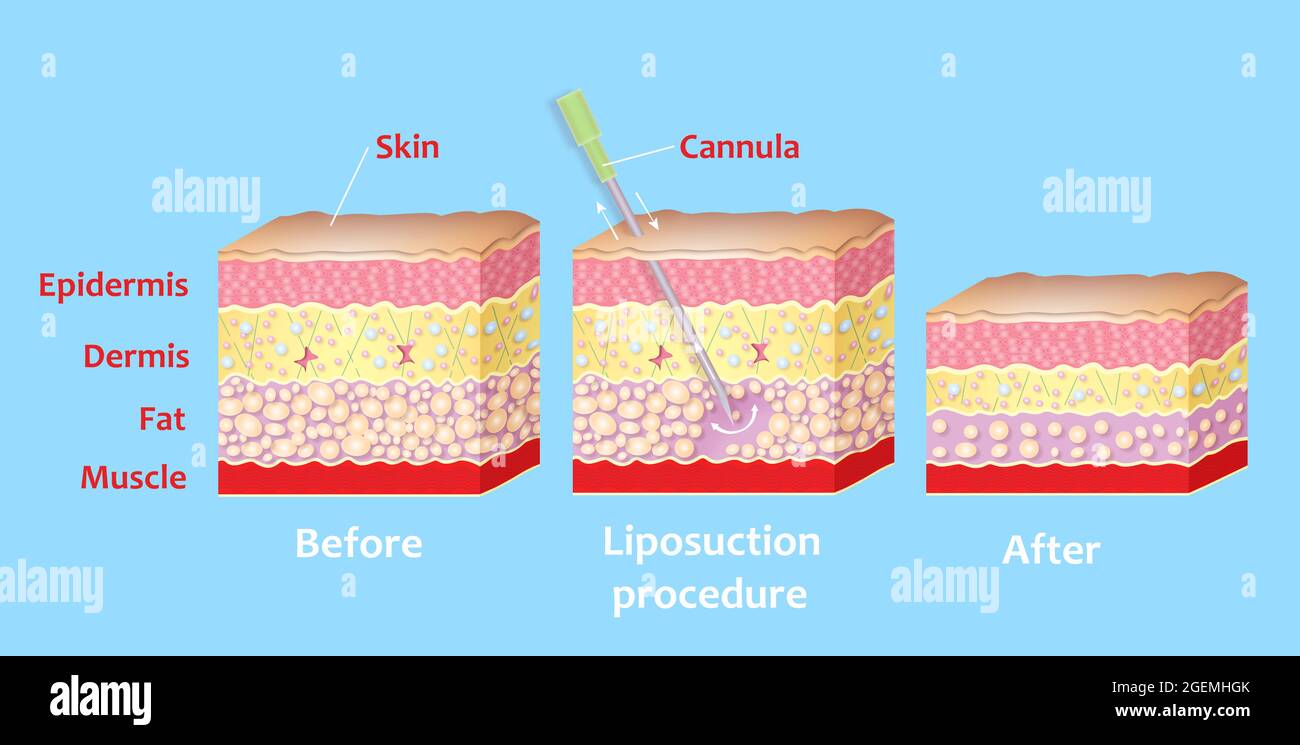 Mechanism of liposuction. Suction-assisted liposuction. Hollow tube or ...