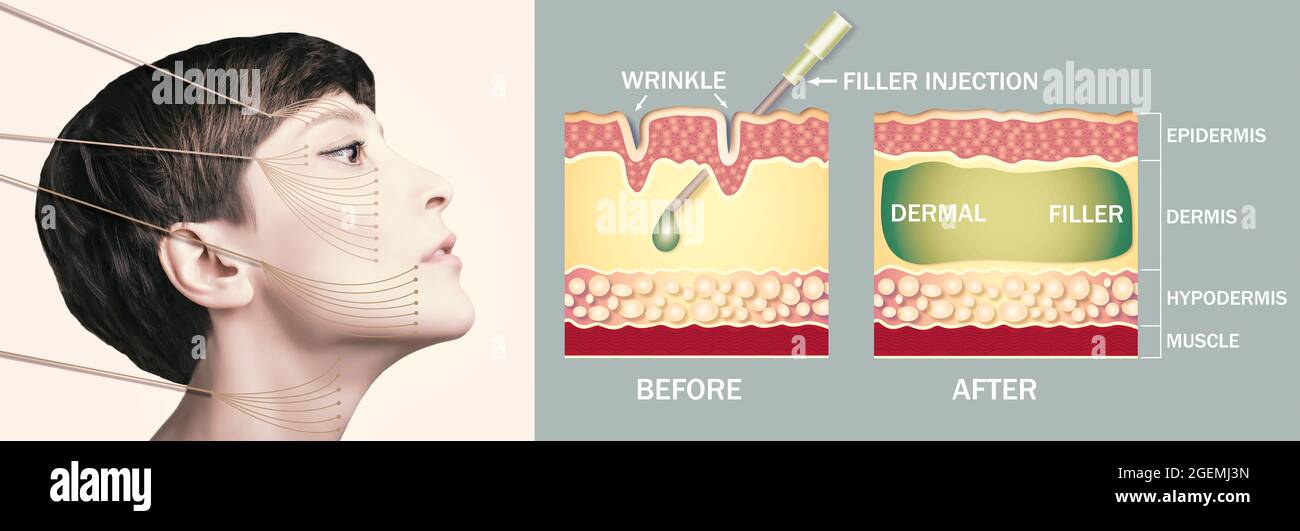 Treatment areas for anti-wrinkle injection. Young female with clean ...