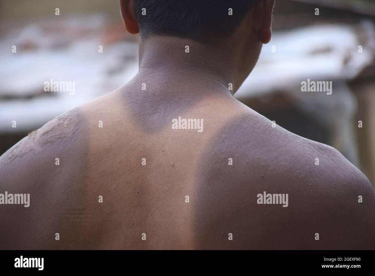 Extra sun-scorched shoulders and neck skin, The body part between the ...