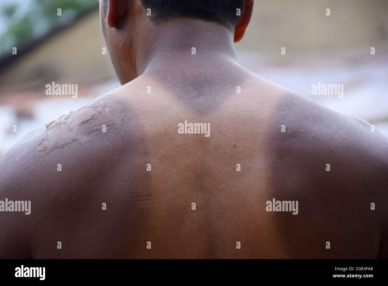 Skin reaction hi-res stock photography and images - Alamy