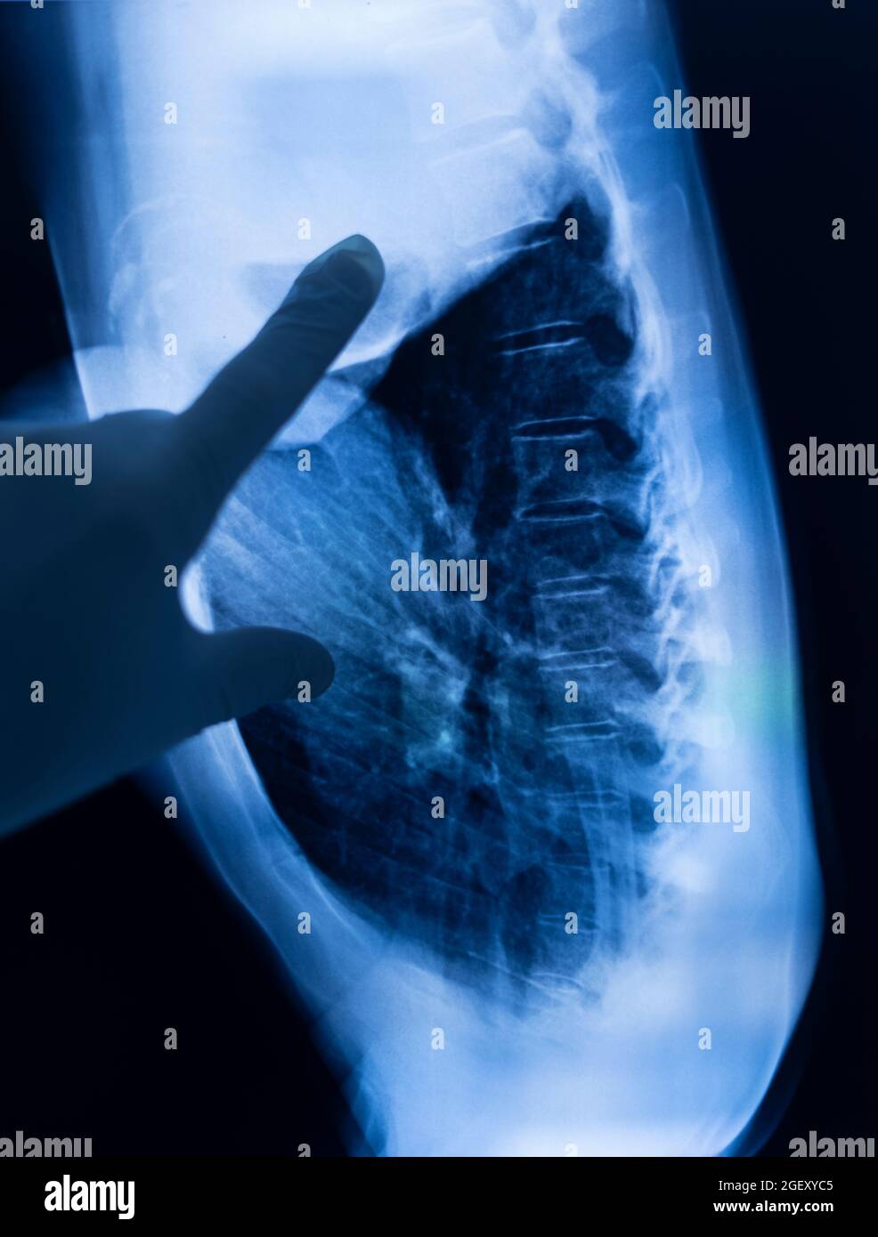 Lungs ribs x-ray scan test result Stock Photo - Alamy