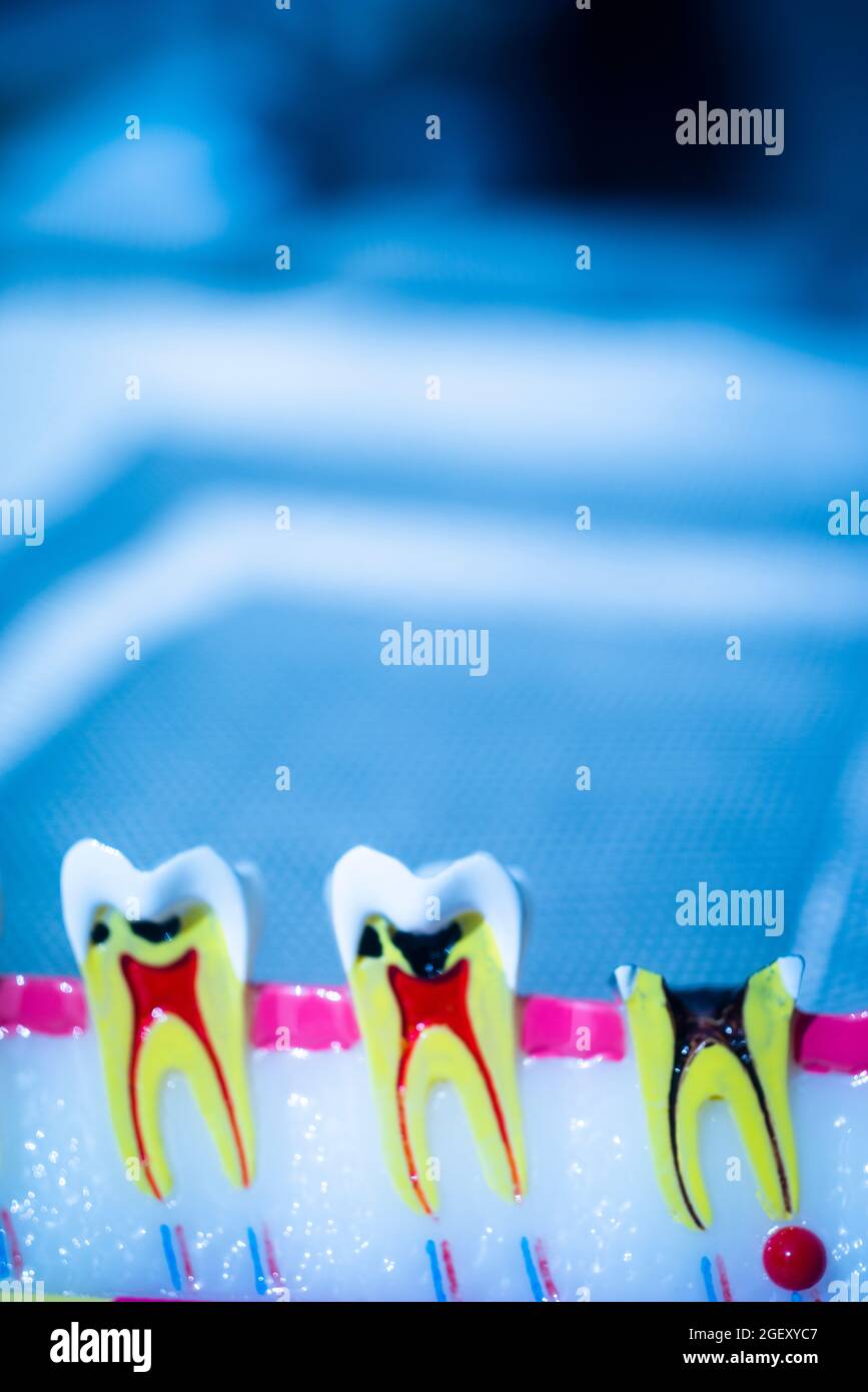 Dental tooth model showing teeth decay, gums and root canal Stock Photo ...