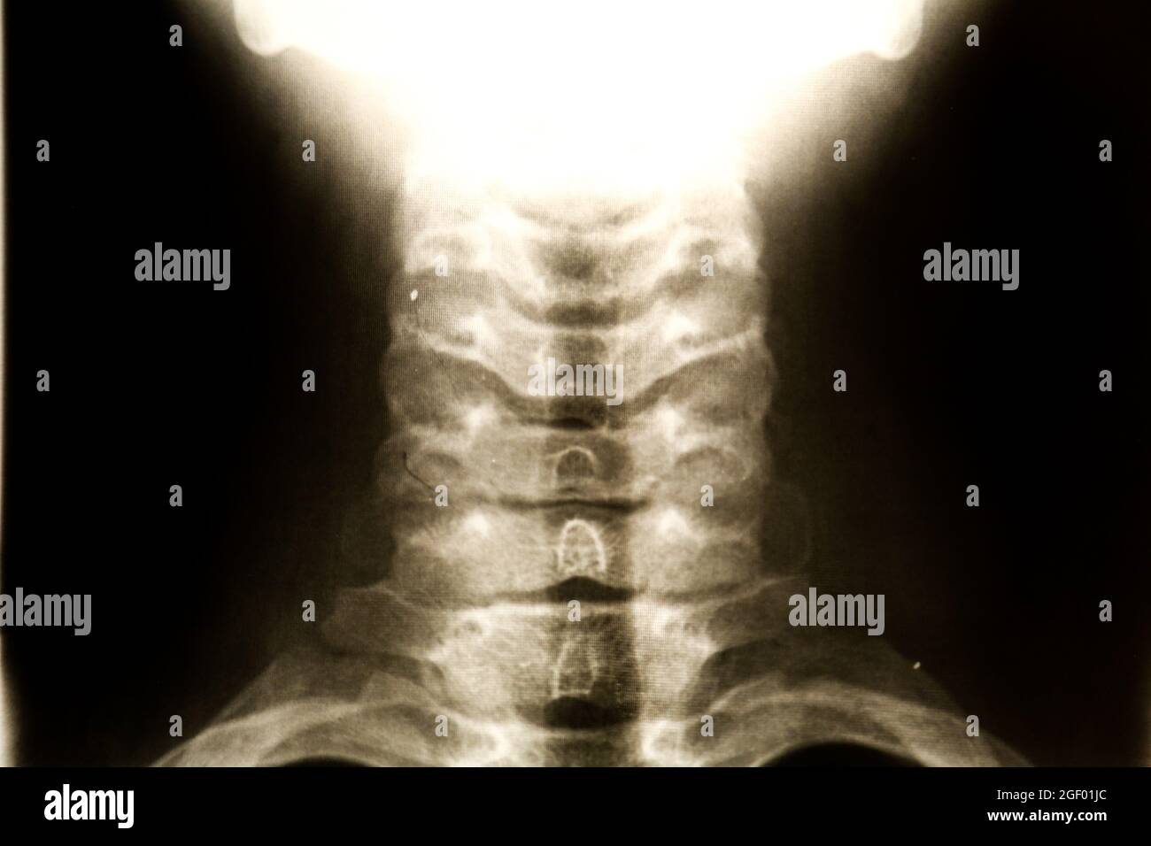 Neck X-ray Shaped Texture Stock Photo - Alamy