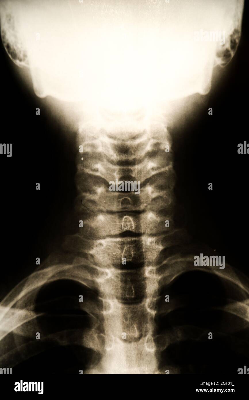 Neck X-ray Shaped Texture Stock Photo - Alamy