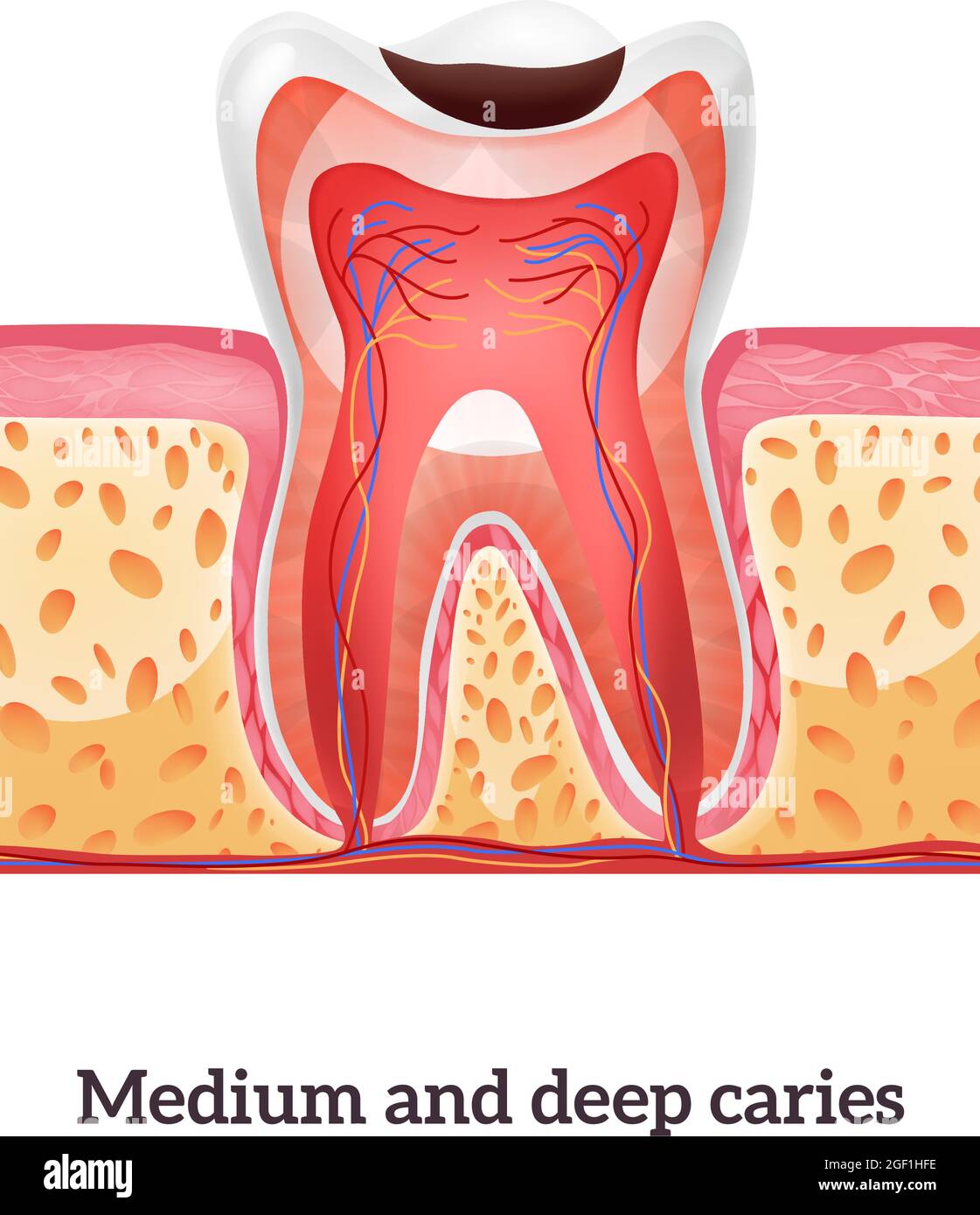 Realistic tooth structure with medium and deep caries vector ...