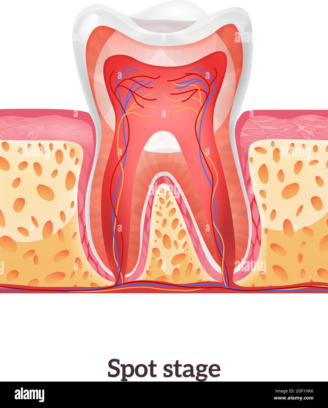 Tooth anatomy with spot stage of caries realistic vector illustration ...