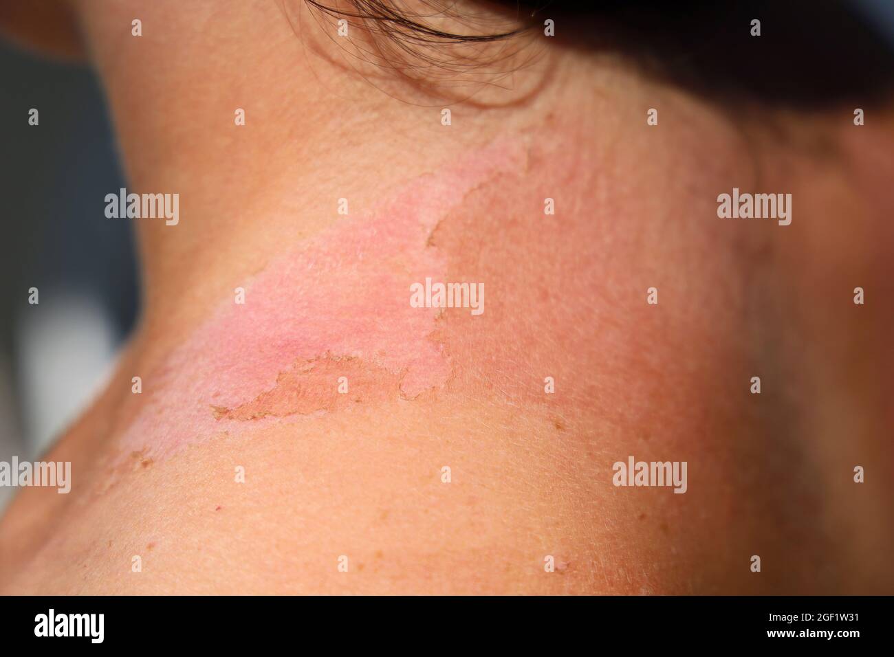 Sunburn back hi-res stock photography and images - Alamy