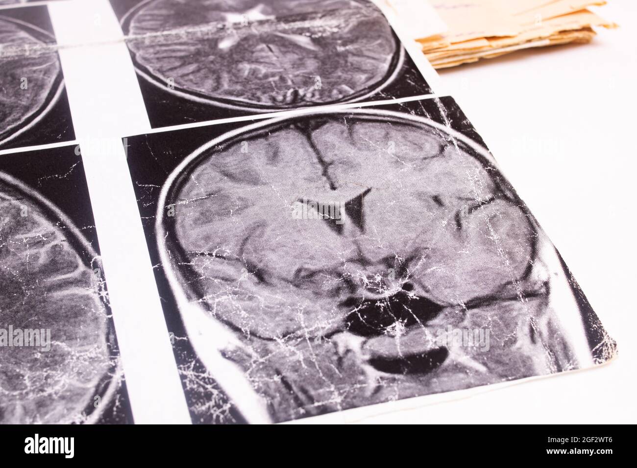 Mri brain scan on skull x ray hi-res stock photography and images - Alamy