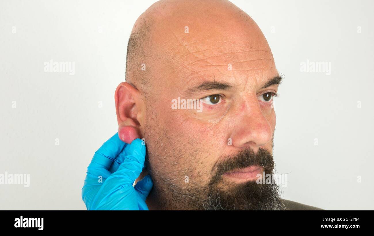 Swollen abscess hi-res stock photography and images - Alamy