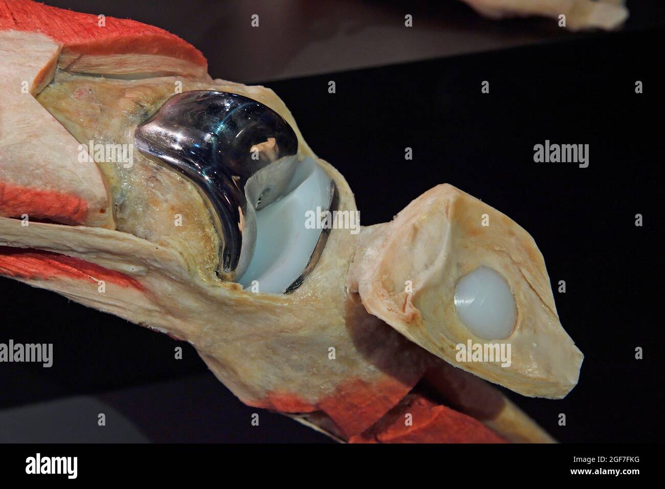 Preparation, plastinate, artificial knee joint, Koerperwelten Museum ...
