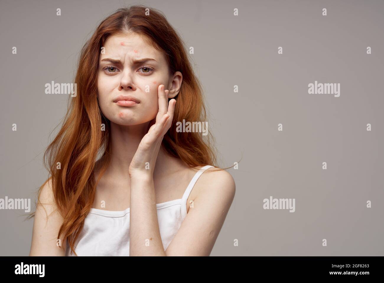 beautiful woman with pimples on the face hygiene light background Stock ...