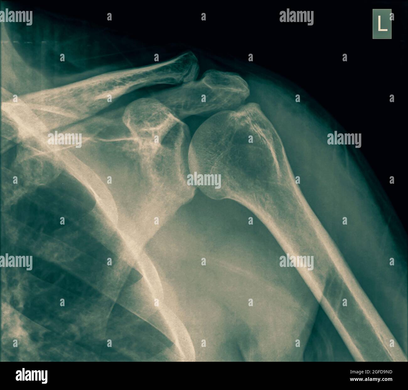 Collarbone dislocation hi-res stock photography and images - Alamy