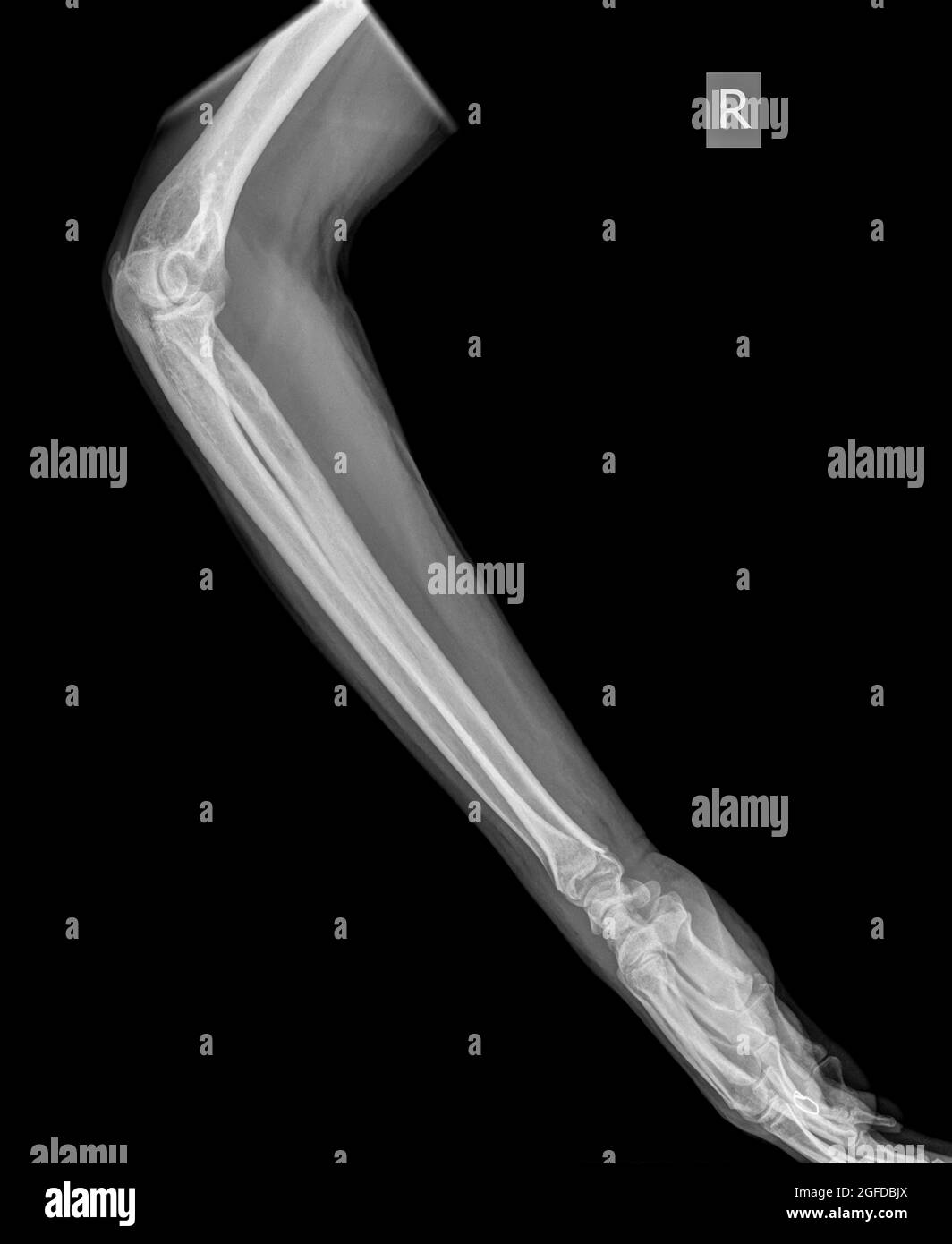 Xray Broken Arm