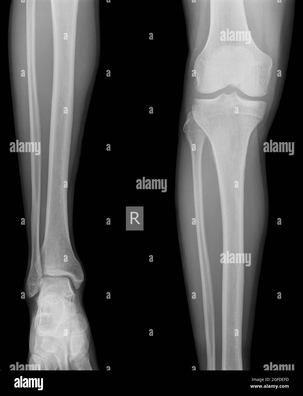 Lattimore Dislocated Knee