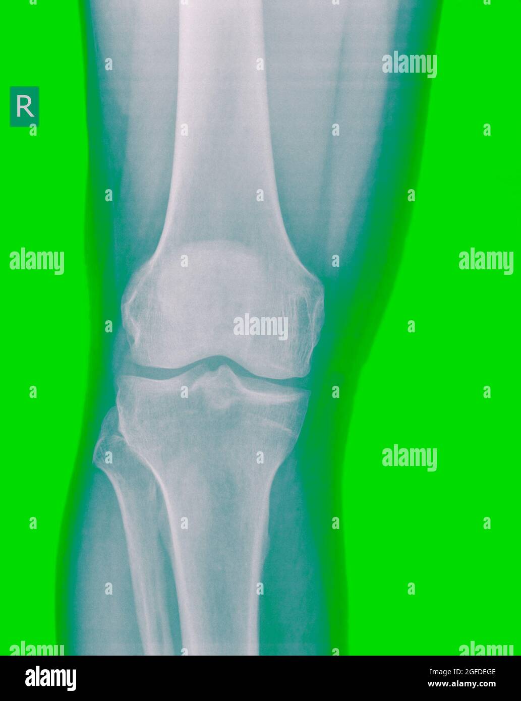 Patella fracture hi-res stock photography and images - Alamy
