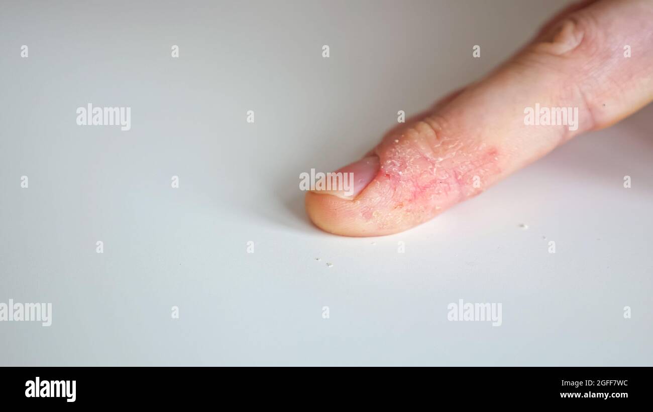 Psoriasis Hand High Resolution Stock Photography and Images - Alamy