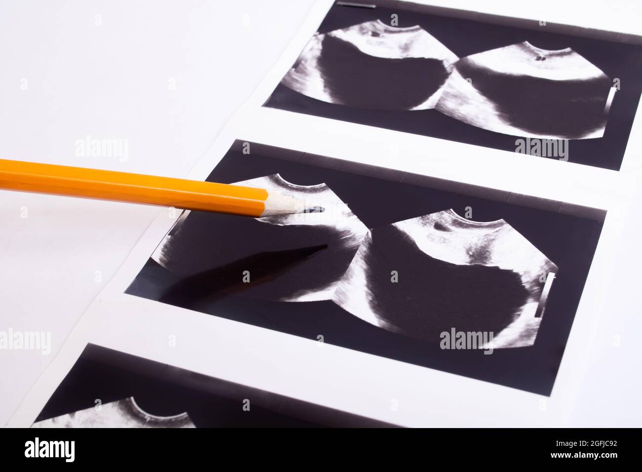 Image of an ultrasound scan of the prostate Stock Photo - Alamy