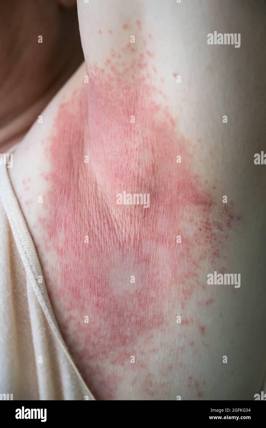 Allergic reaction on the surface of the skin Stock Photo - Alamy