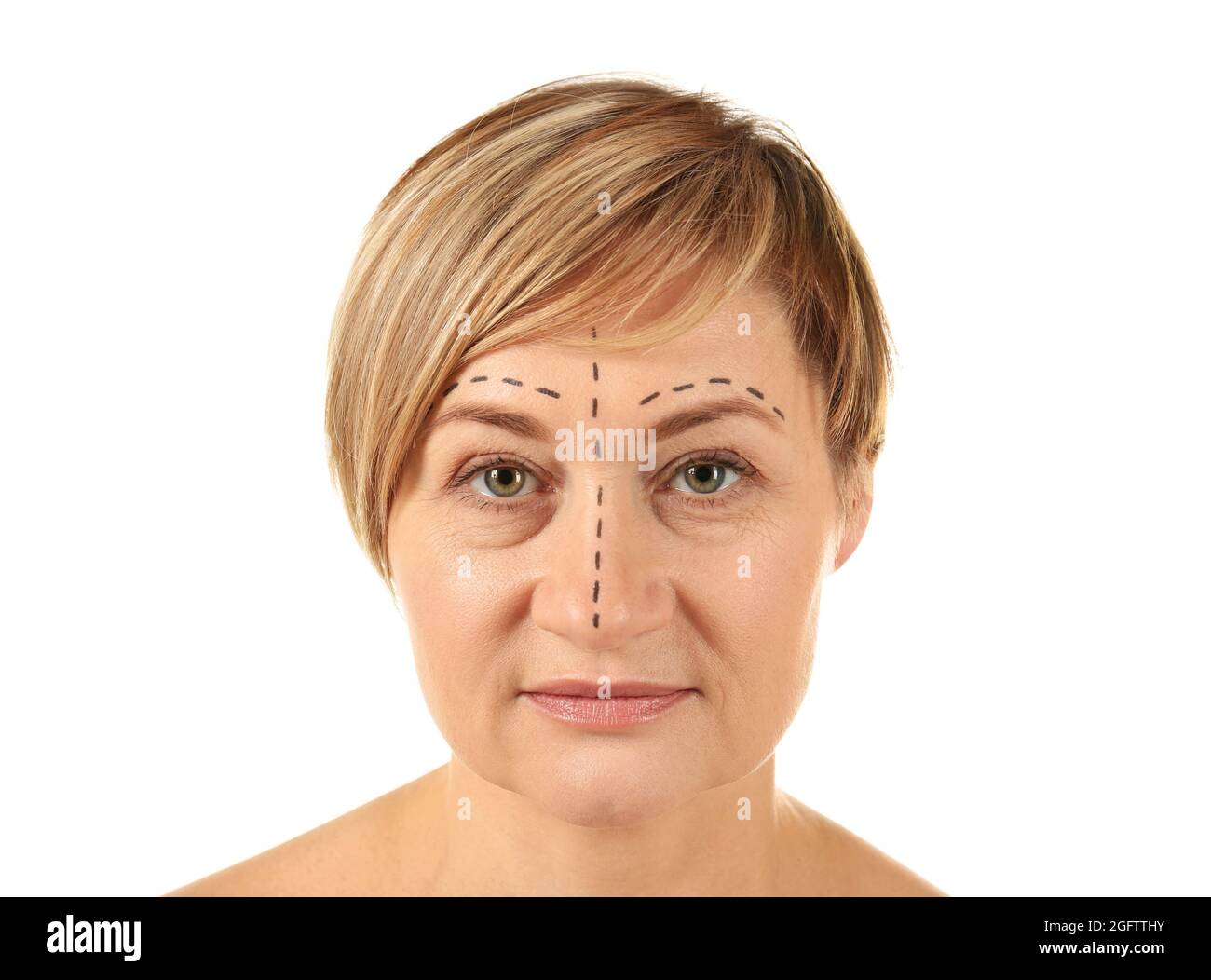 Woman with marks on face for plastic operation Stock Photo - Alamy