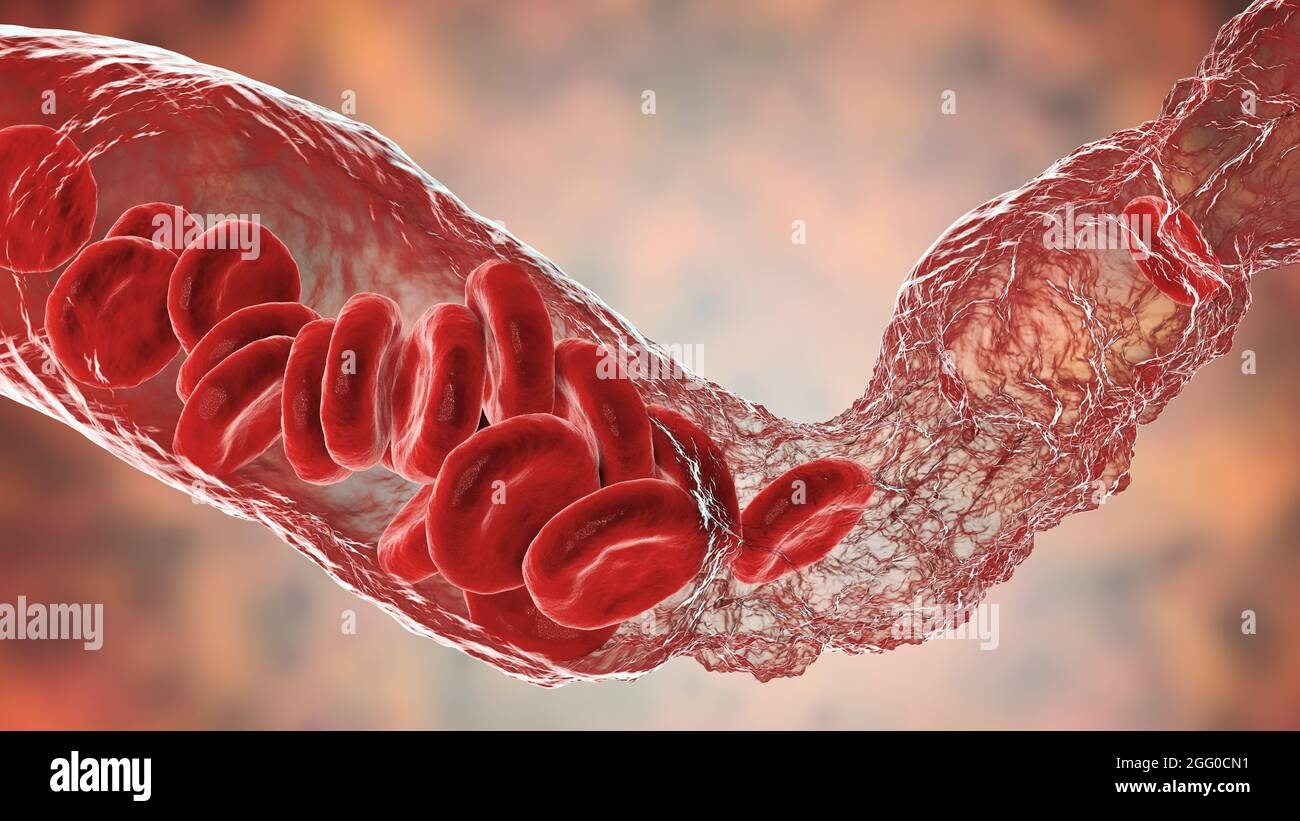 Blood clot, illustration Stock Photo - Alamy
