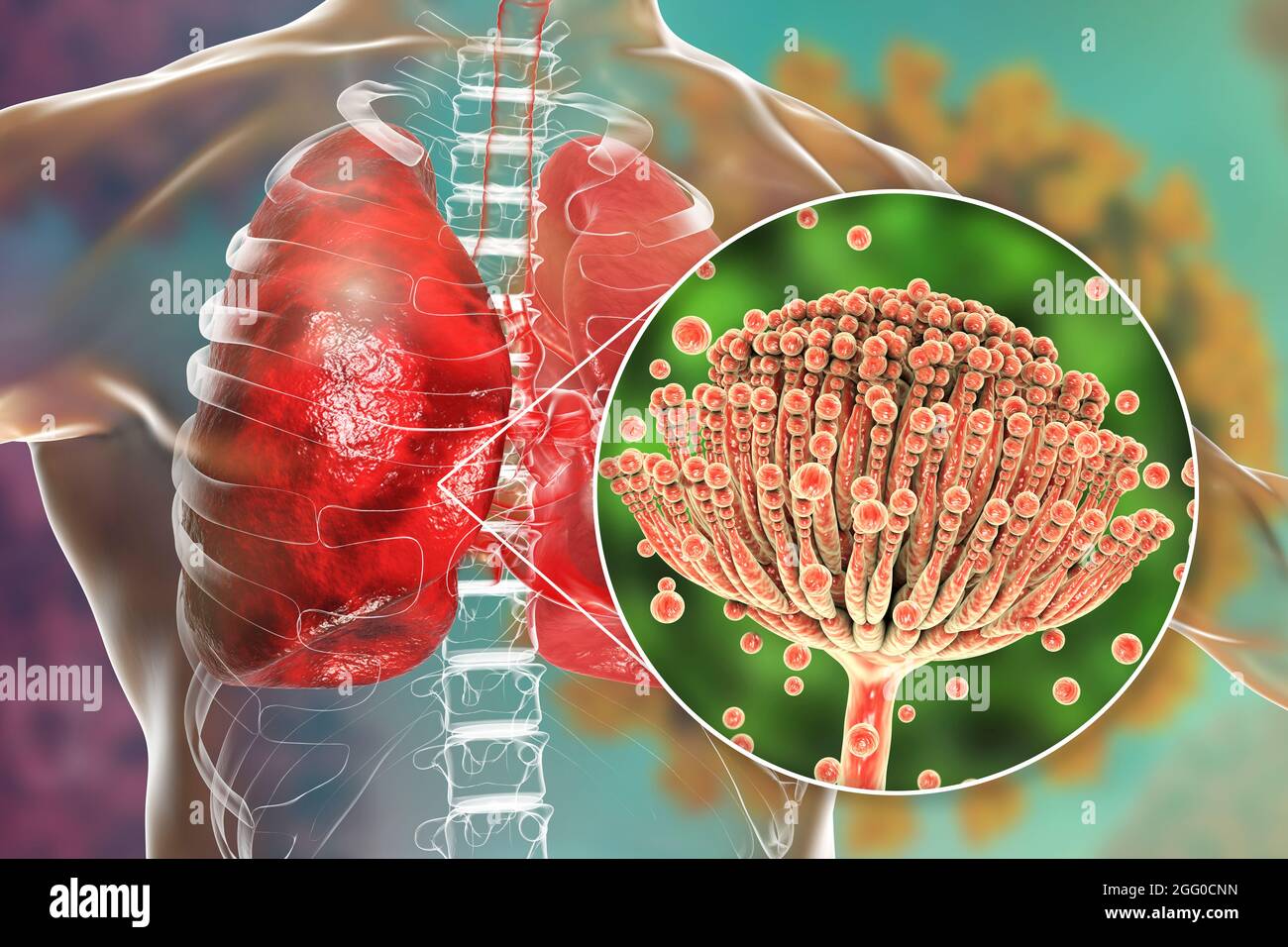 Illustration of a pulmonary aspergillosis, invasion of a lung tissue by ...