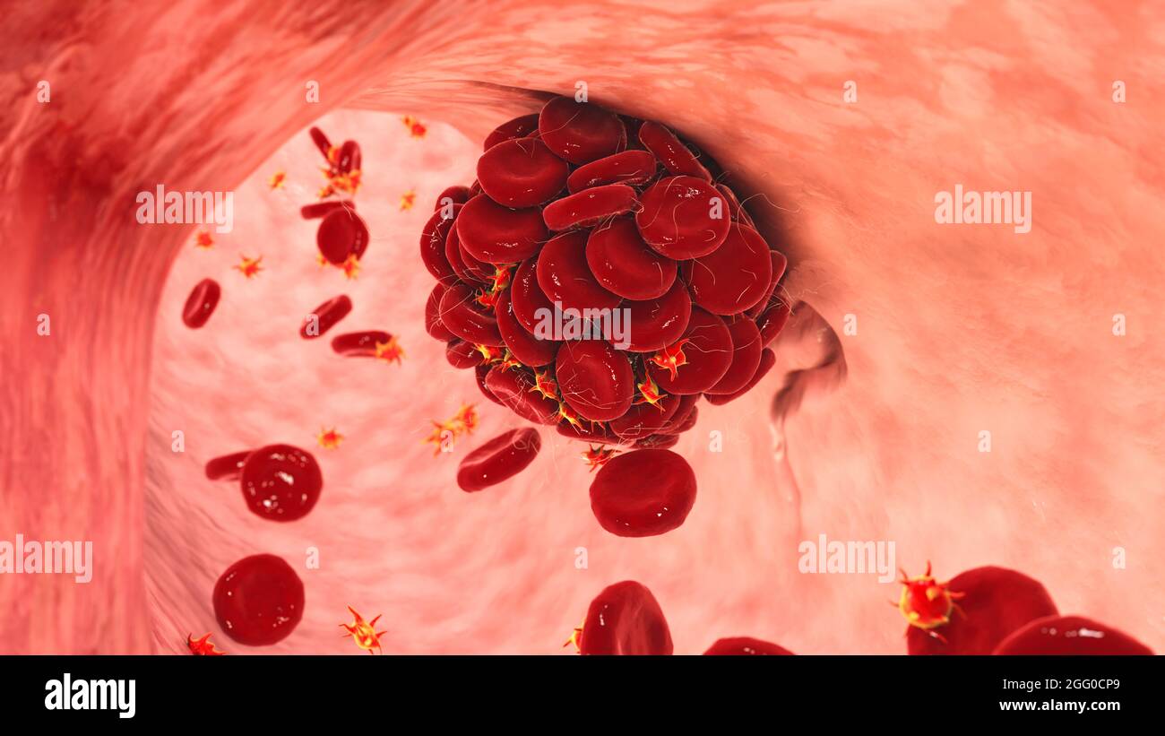 Illustration of a blood clot in damaged blood vessel made of red blood ...