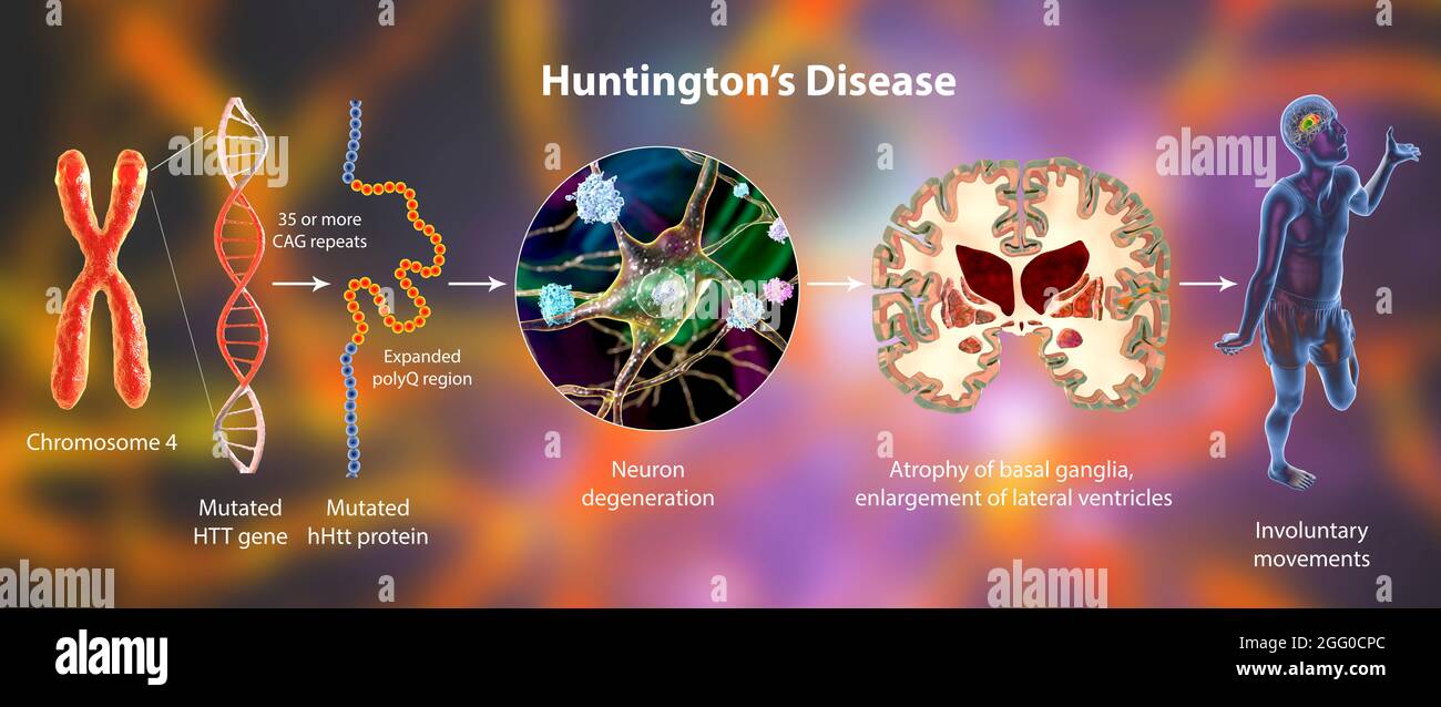Molecular genesis of Huntington's disease, illustration. Expansion of ...