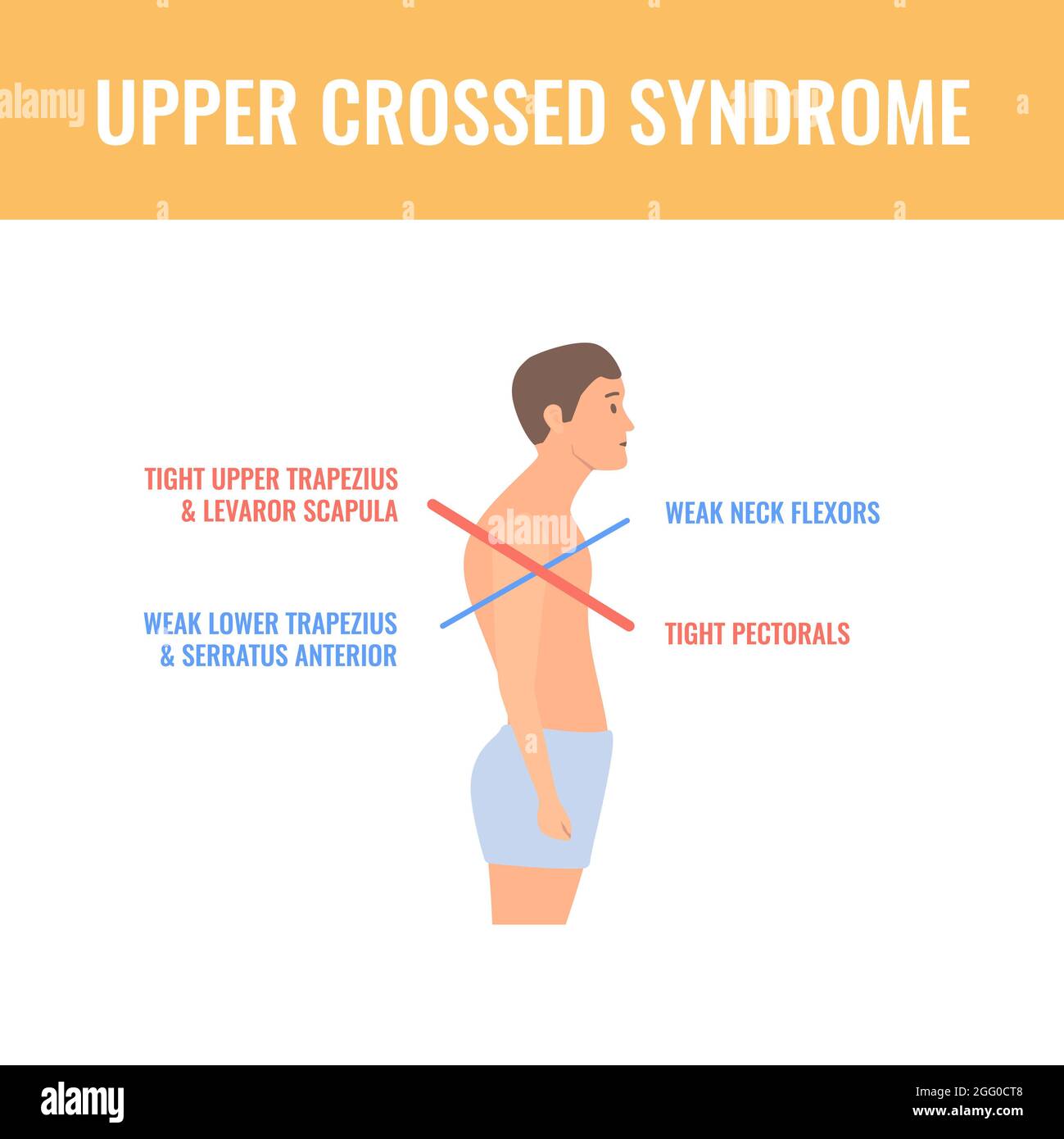 Upper crossed syndrome, conceptual illustration Stock Photo - Alamy