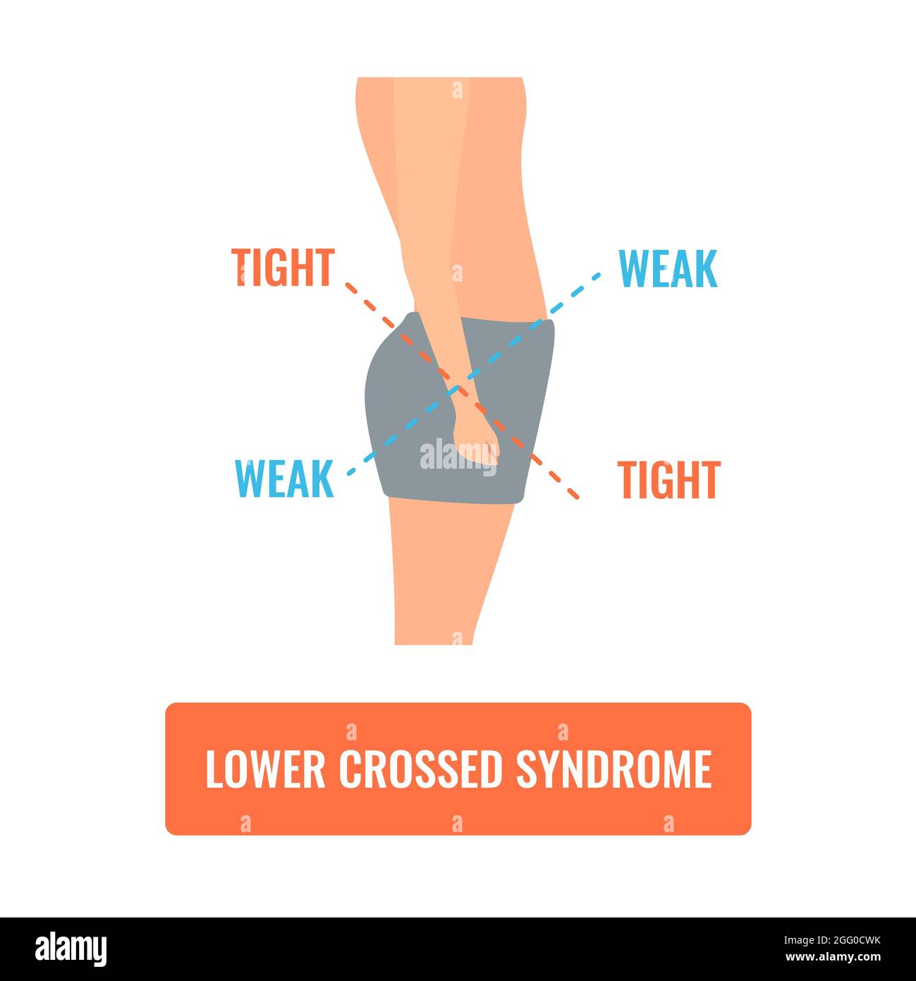 Lower crossed syndrome, conceptual illustration Stock Photo - Alamy