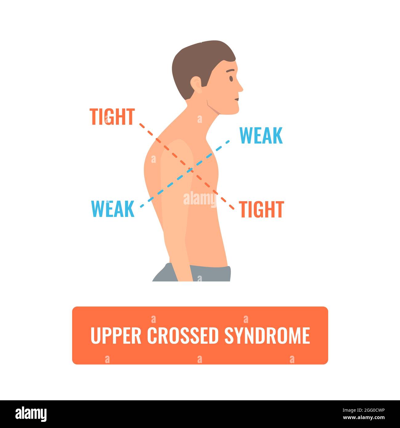 Upper crossed syndrome, conceptual illustration Stock Photo - Alamy